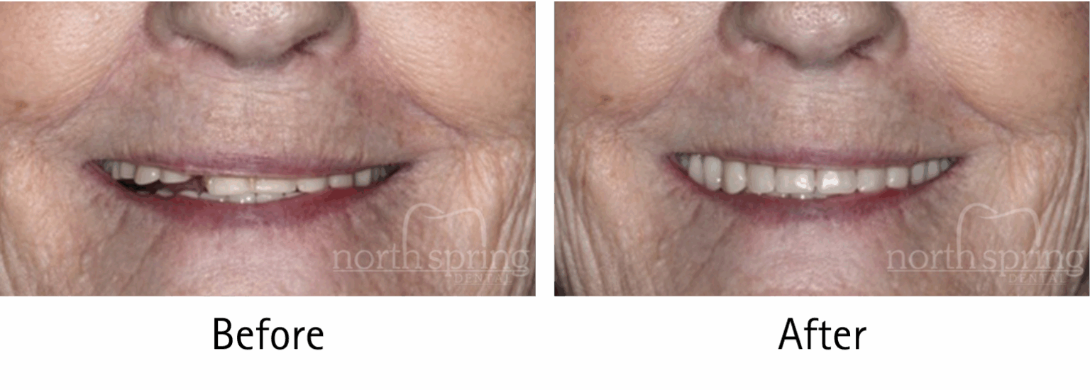 Dentures Smile Gallery | Springfield, OH